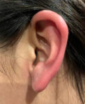 Isolated Aural Erythromelalgia or Red Ear Syndrome