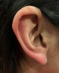 Isolated Aural Erythromelalgia or Red Ear Syndrome