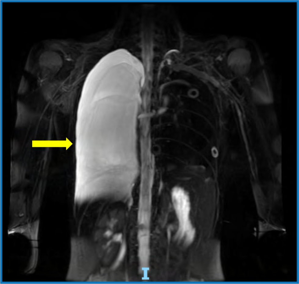 A Rare Case of Persistent Chylothorax
