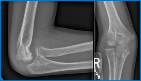 Panner’s Disease: A Case Report
